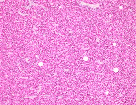Pathology Outlines Burkitt Lymphoma