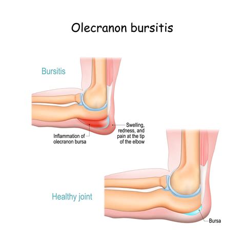 Olecranon Bursitis Physioflow Pt Physical Therapy Vancouver Wa