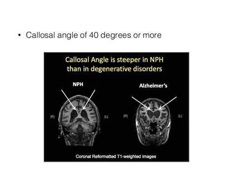 Surgical Management Of Nph