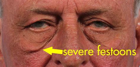 What Are Festoons Dr Brett Kotlus Cosmetic Oculoplastic Surgeon Nyc