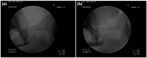 Retrograde Ejaculation Due To Posterior Urethral Stricture A Rare Case