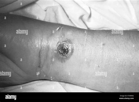 A Cutaneous Anthrax Lesion On The Arm Of A 50 Year Old Female This 50