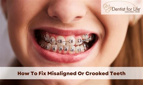 Find Out The Ways To Fix Misaligned Or Crooked Teeth