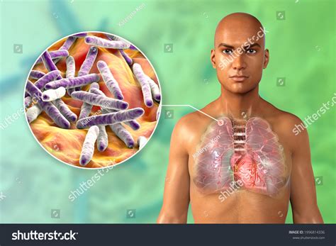 Secondary Tuberculosis Lungs Apical Nodule 3d Stock Illustration