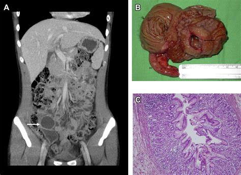 Enterogenous Cyst Of The Ileum Presenting As Acute Appendicitis Chen