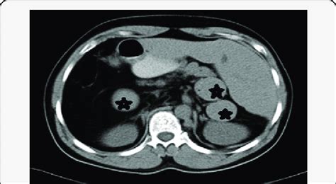 Ct Abdomen With Axial View Revealing Polysplenia Three Black Stars