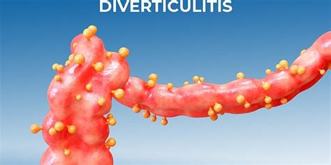 Surgery For Recurrent Diverticulitis Boosts Qol Worldmedicinefoundation