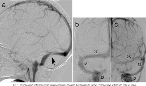 Figure 1 From Efficacy Of Endovascular Stenting In Dural Venous Sinus