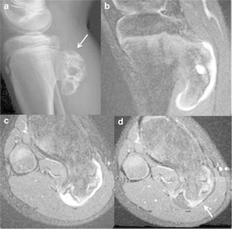 Benign Solitary Osteochondroma Of The Tibia In A 15 Year Old Boy
