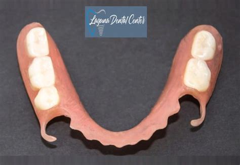 Removable Partial Denture Mandibular