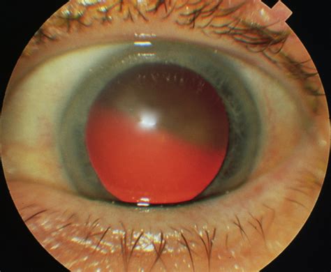 Red Reflex Vitreous Haemorrhage And Retinal Detachment Gp Eyes
