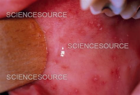 Measles Kopliks Spots In Mouth Stock Image Science Source Images