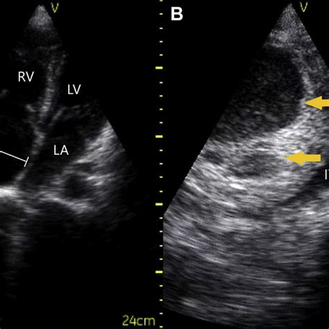 Pocus Findings A Apical Four Chamber View Demonstrates Thickened And Download Scientific