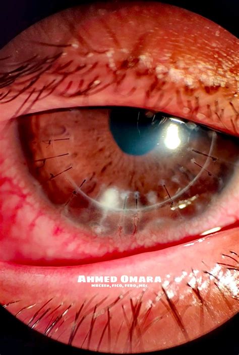 Ahmed Omara On Linkedin Suture Abscess