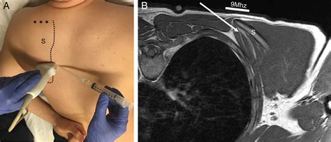 Scapulothoracic Bursitis