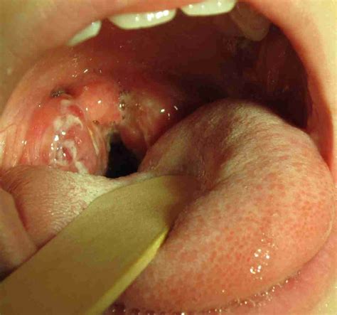 The Complete Guide To Streptococcal Pharyngitis Symptoms Treatment