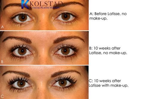 Latisse Eyelash Results Dr Kolstad San Diego Facial Plastic Surgeon