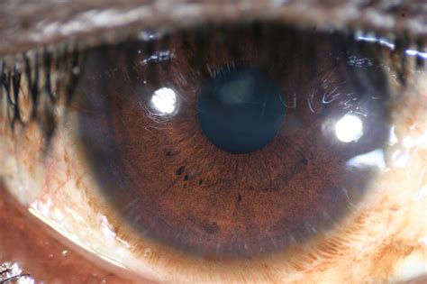 Modern And Multidimensional Iridology Iris Signs At Internal And External