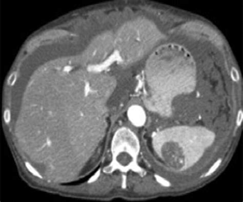 Calcified Splenic Lesions Pattern Recognition Approach On Ct With