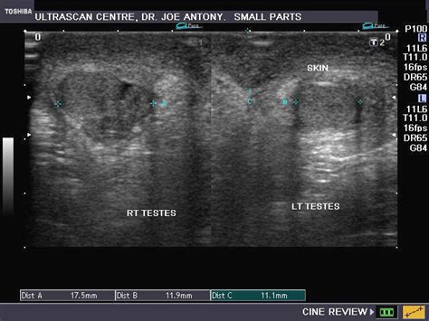 Scrotal Edema Ultrasound