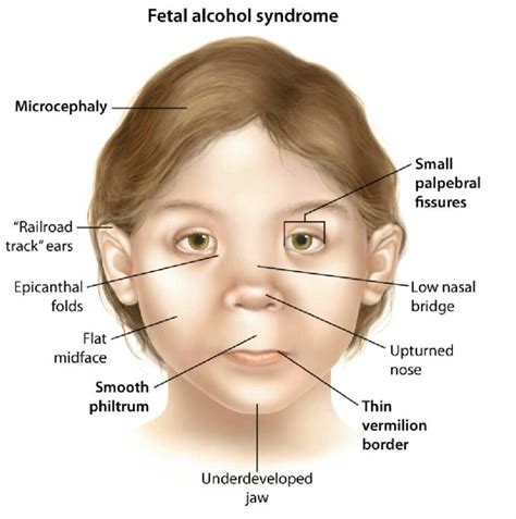 Fetal Alcohol Syndrome Causes Symptoms Risk Factors Diagnosis Fetal
