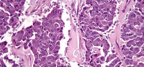 This Modified Common Cold Virus Specifically Targets And Kills Cancer