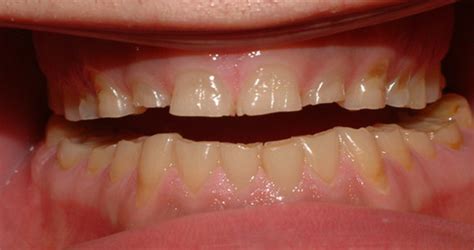 Bruxism Teeth Grindingclenching Crestmead Dental