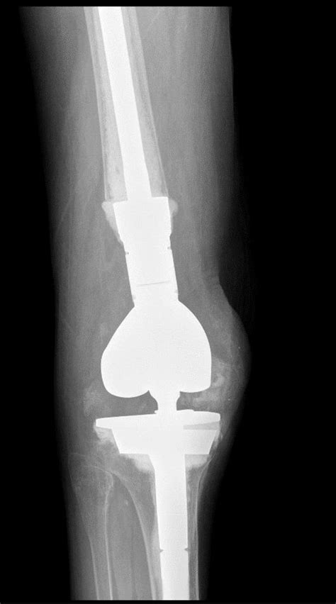 Cpt Code For Retrograde Intramedullary Nailing Femur Nail Ftempo