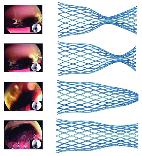 Peristaltic Movement Comparison Between Fe Simulation And Endoscopic