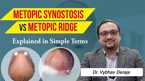 What Is The Difference Between Metopic Synostosis And Metopic Ridge