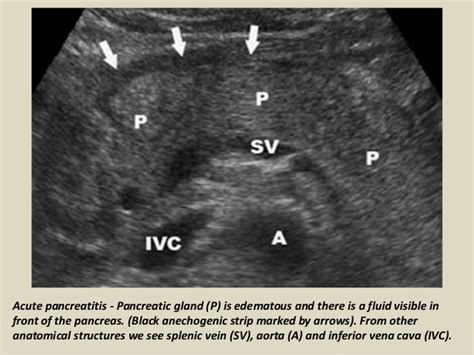 Ultrasound Of Pancrease In Radiology