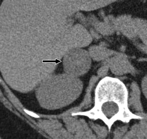 Adrenocortical Carcinoma The Range Of Appearances On Ct And Mri Ajr