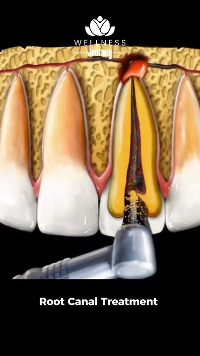 How Does A Root Canal Save Your Tooth 🦷 Step By Step Animation