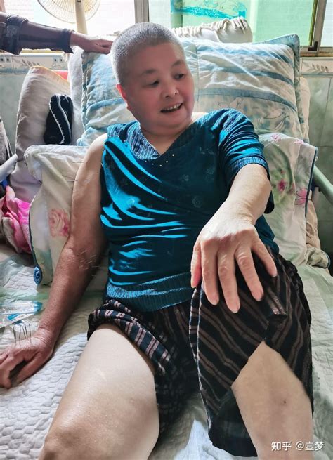 脑出血患者 知乎