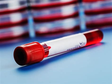 Fta Abs Blood Test Purpose Procedure And Results