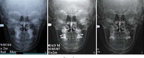 Maxillary Retrusion Semantic Scholar