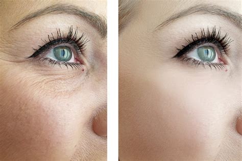 Botox Side Effects Should I Be Worried