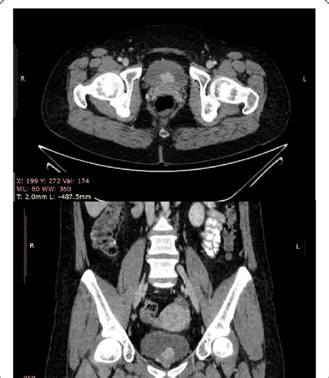 Ct Scan Showing An Intraluminal Bladder Mass Download Scientific Diagram