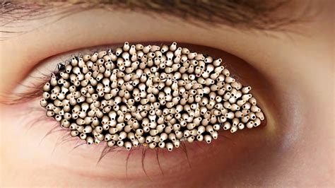 Asmr Eye Treatment Animation Deep Cleaning And Infestation Remove Eye