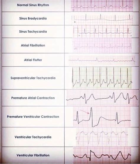 Electrocardiogram Reading