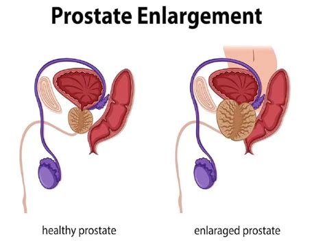 Enlarged Prostate When Should You Consult A Urologist