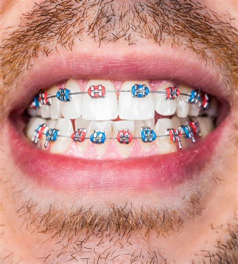 Premium Photo Closeup Of A Mans Teeth With Braces On Metal Braces