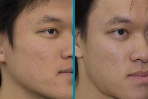 Pitted Acne Scars Before After