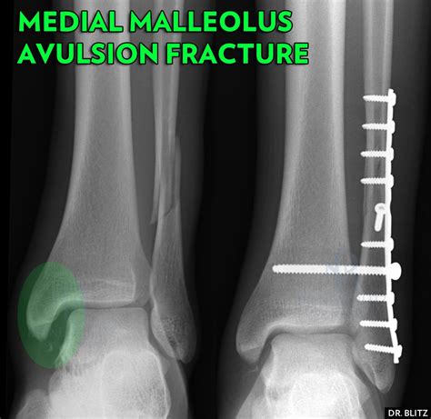 Fracture Of The Posterior Malleolus A Paradigm Shift Bghudw