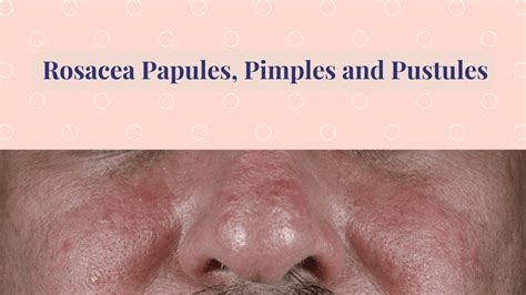 Rosacea Acne Papulopustular Rosacea
