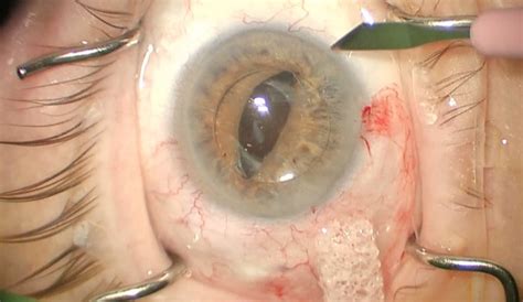 Millennialeye Technique For Iris Sutured Iol Using A 10 0 Prolene Suture