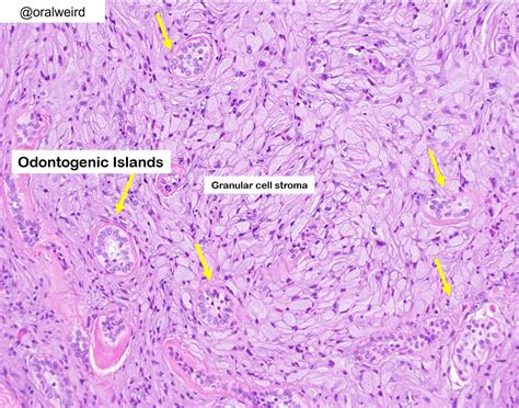 Central Odontogenic Fibroma Histology