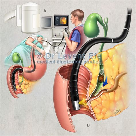 Ercp Dr Efes Medical Art Store Medical Illustrations And Surgical Art