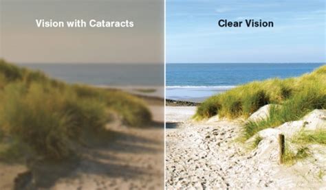 About Cataracts Ocala Eye