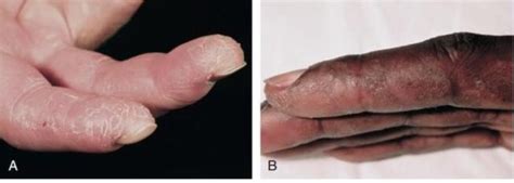 皮肌炎与多发性肌炎：如何区分、诊断？ 丁香园